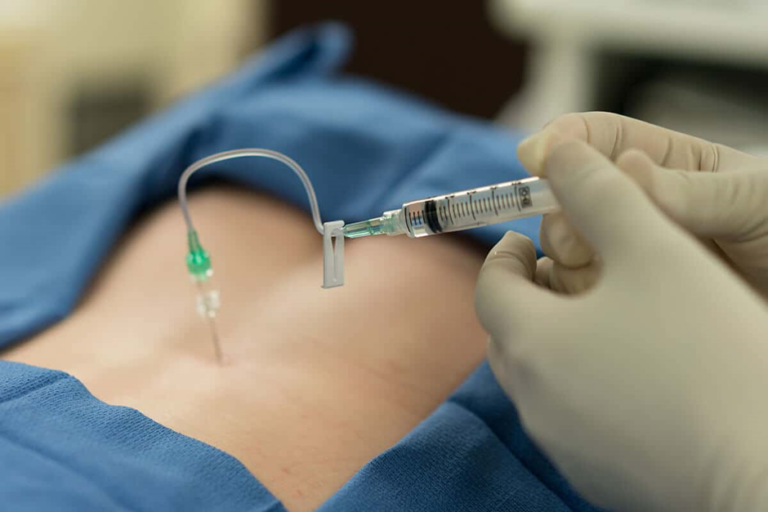 Epidural for Pain Relief: Understanding the Procedure and Benefits ...