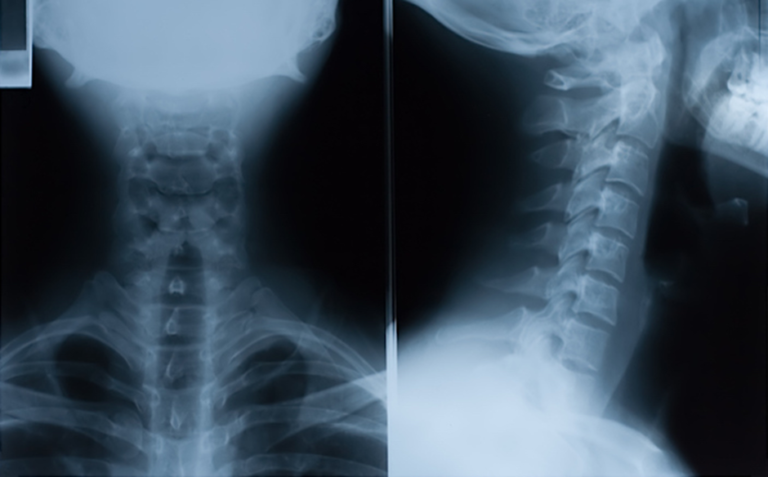 X-Rays and MRIs for Back Pain: Which Imaging Option Is Right for You ...