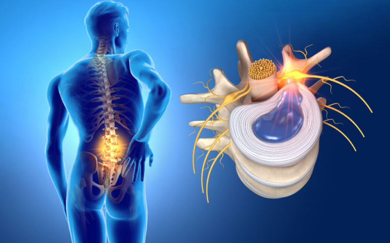 Sciatica vs. Herniated Disc: Deciphering the Differences and Treatments ...