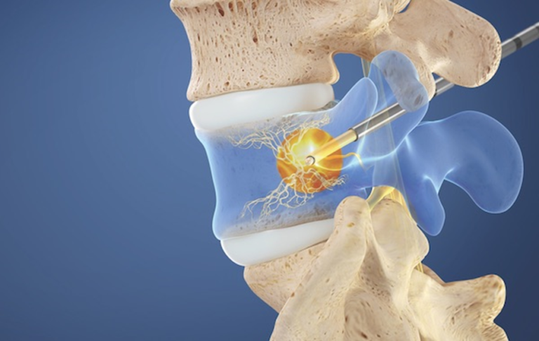 Intercept Procedure: A Minimally Invasive Solution for Chronic Back ...