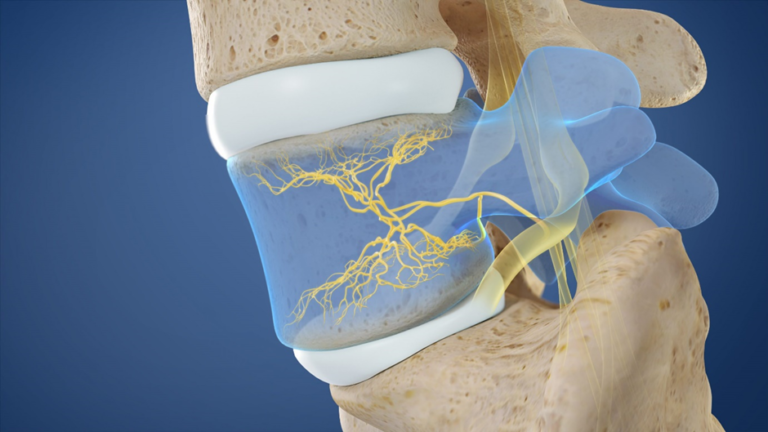 Living Pain-Free with Intracept: A Comprehensive Guide to the Procedure ...
