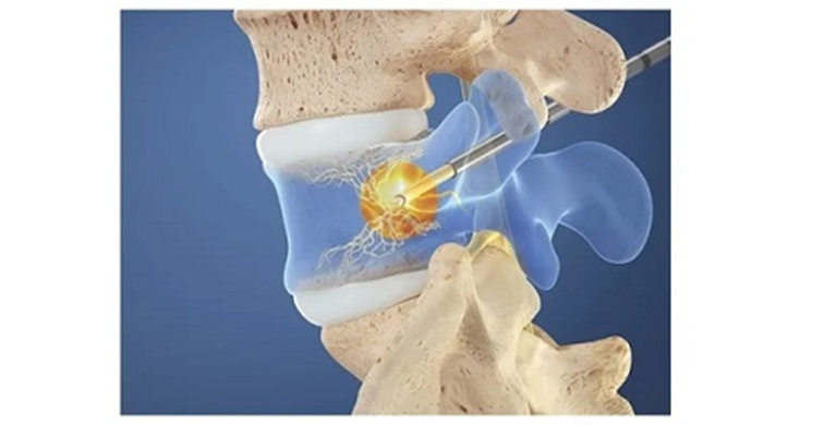 Intracept for Chronic Back Pain: How It Works and Who Benefits ...